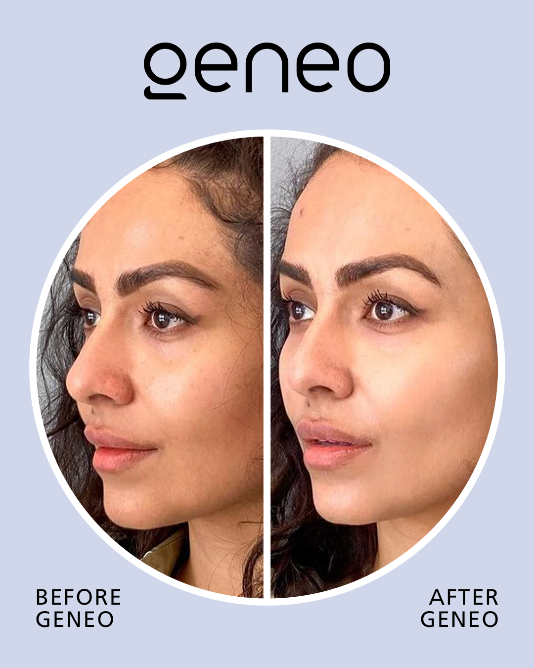 Before & After GENEO